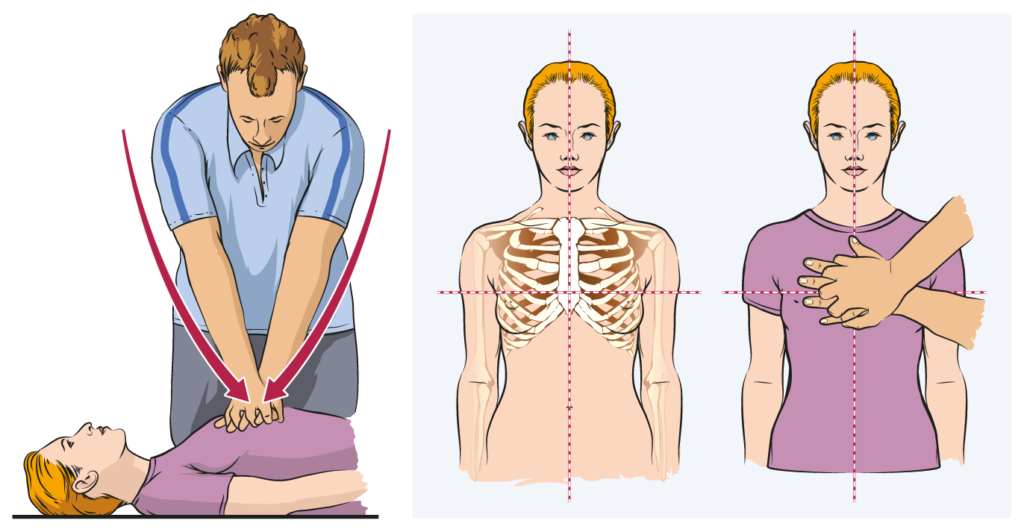 Kardiopulmonale Reanimation (CPR) | Pflegerio