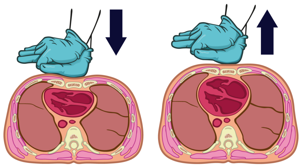 Kardiopulmonale Reanimation (CPR) | Pflegerio