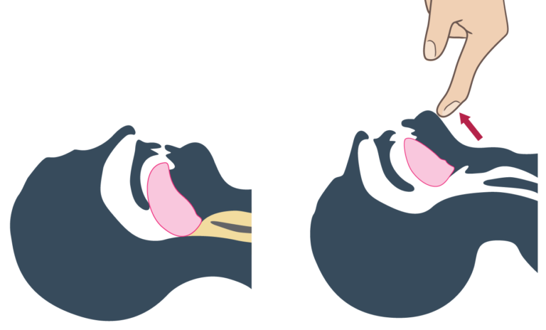 Kardiopulmonale Reanimation (CPR) | Pflegerio