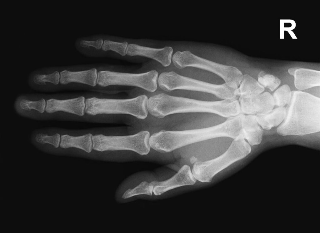 Handwurzelknochen: Anatomie, Funktion, Pathologie | Pflegerio