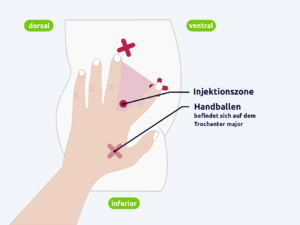 Ventrogluteale Injektion nach Hochstetter | Pflegerio