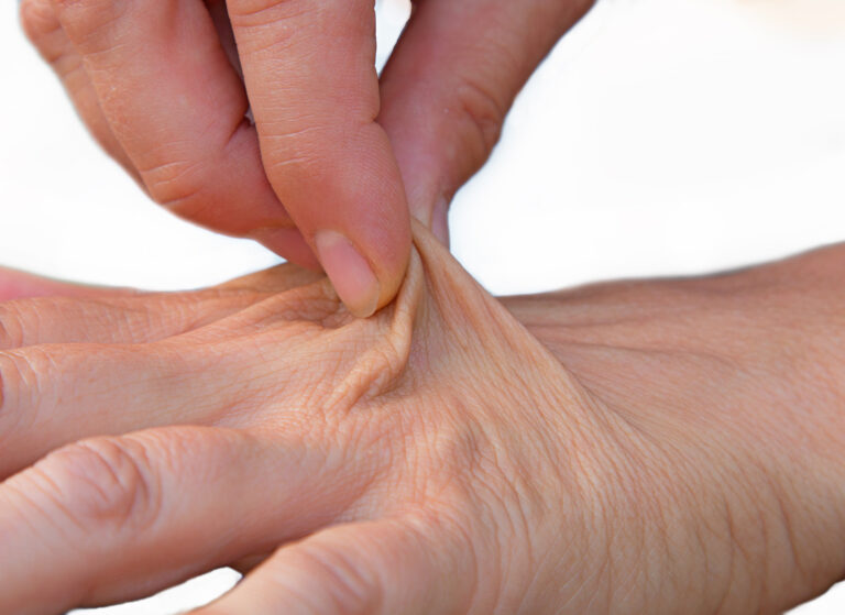 Exsikkose | Pflegerio