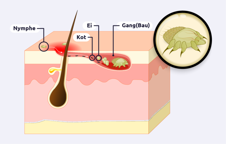 Skabies (Krätze): Symptome, Ursachen und Behandlung | Pflegerio