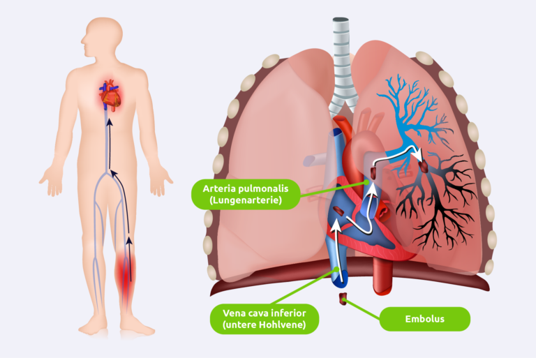 Lungenembolie: Symptome, Ursachen und Behandlung | Pflegerio